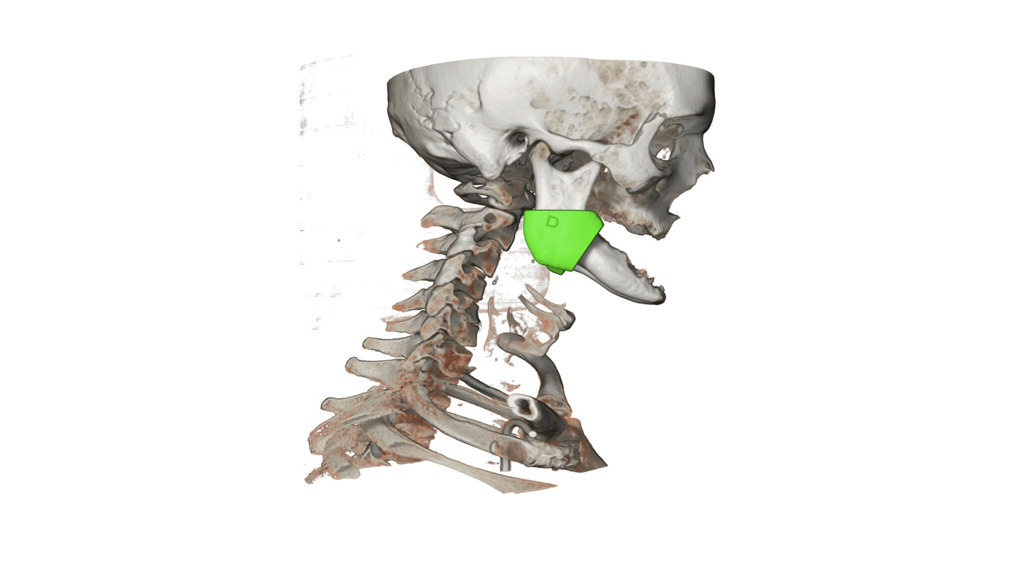 Mandibular resection – cancer – Interspectral